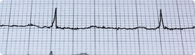 Fibrilação Atrial: Sintomas, Causas e Tratamento Efetivo